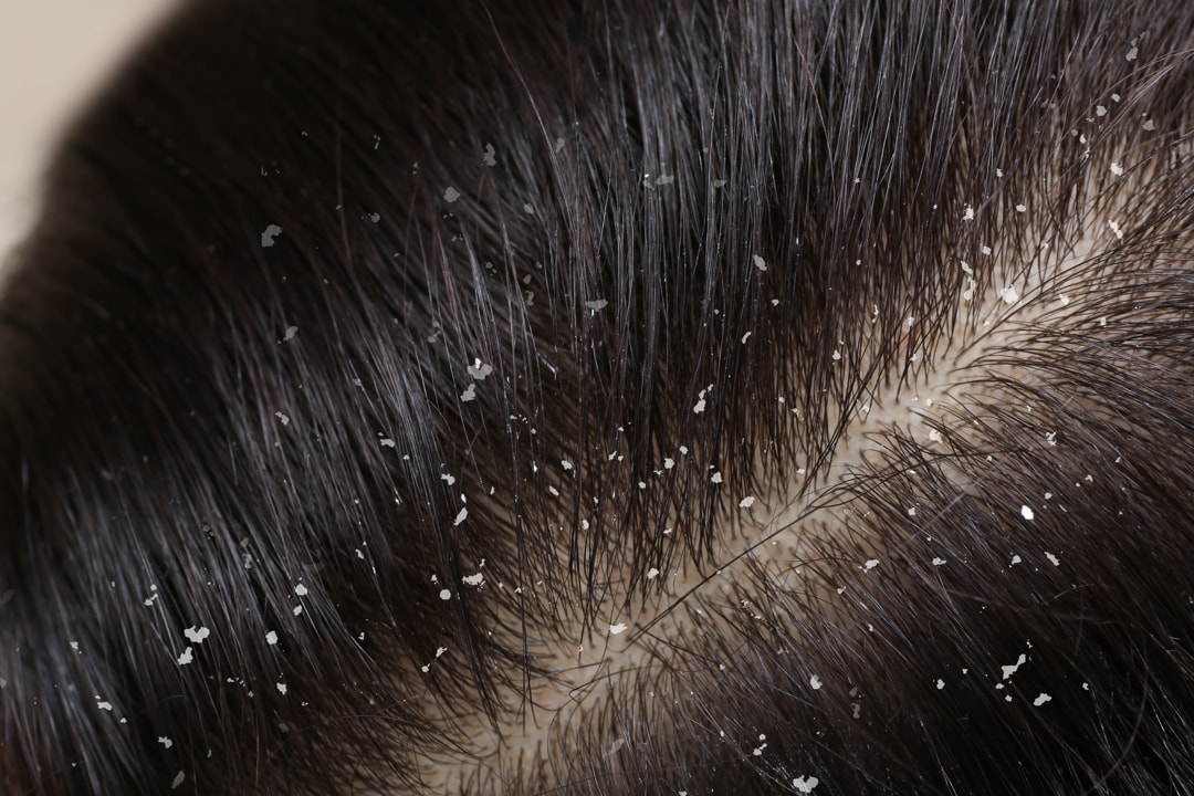 SCALP PSORIASIS VS DANDRUFF - SYMPTOMS AND TREATMENTS