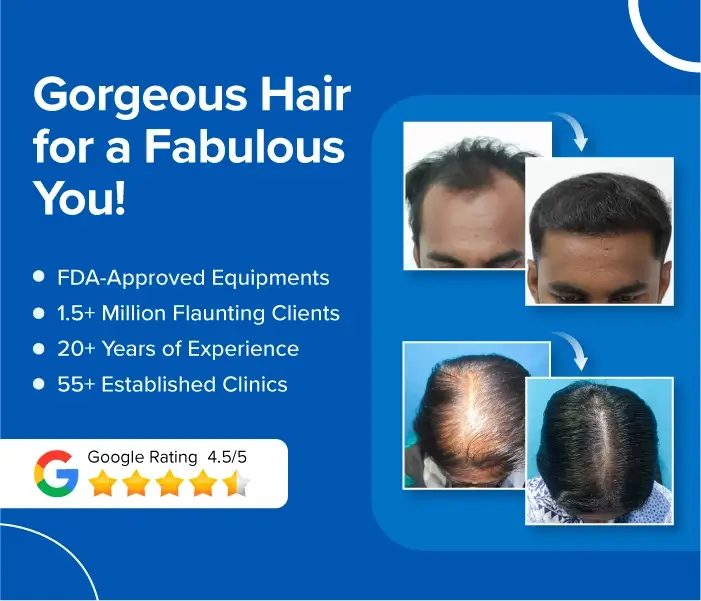 Hair Transplant - Top most Hair Transplant Treatment in India | VCare ...