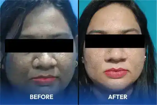 Vcare Trichology - Hair Treatment and Skin Treatment