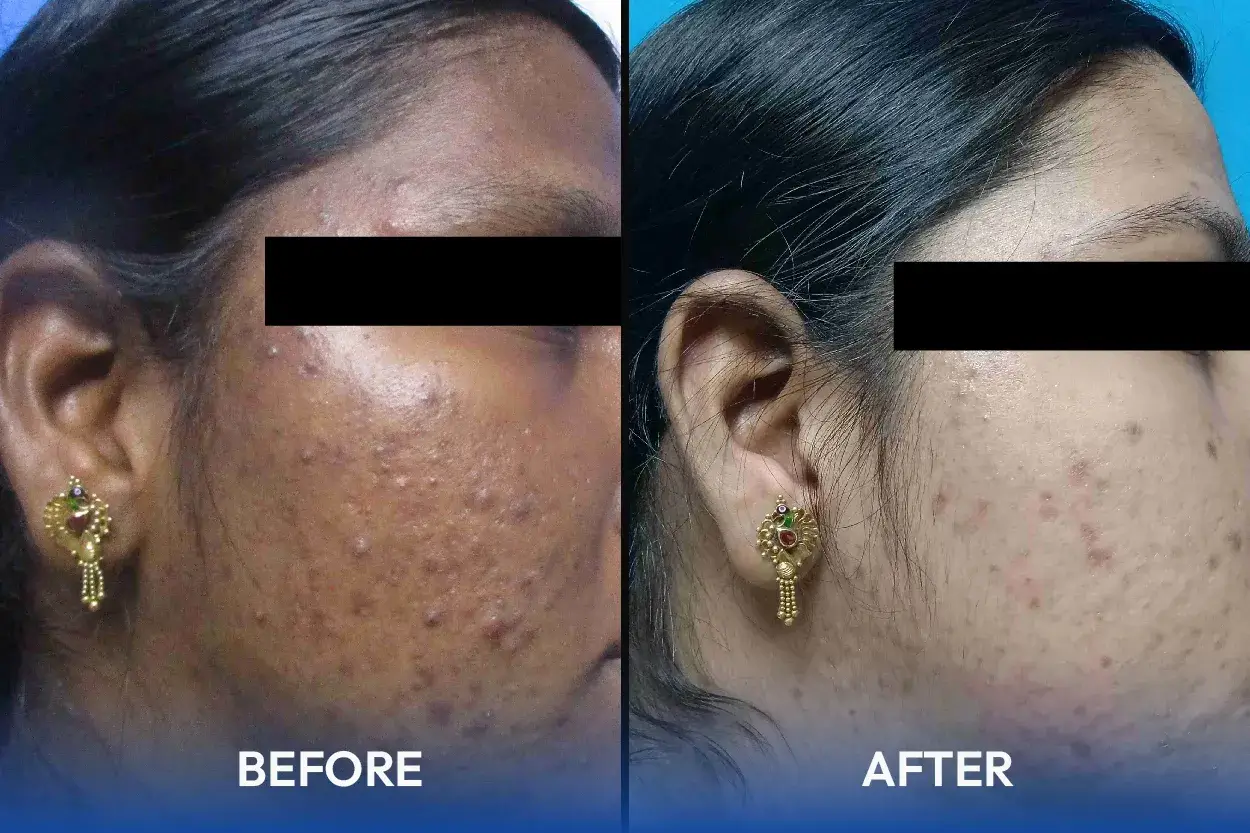 Vcare Trichology - Hair Treatment and Skin Treatment