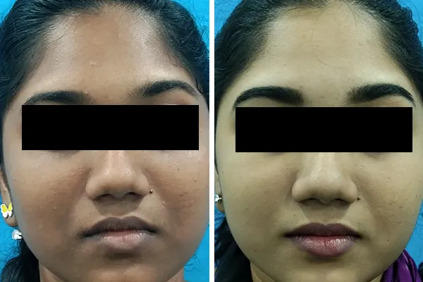 Hydrafacial® - The best skin care clinic in India | VCare