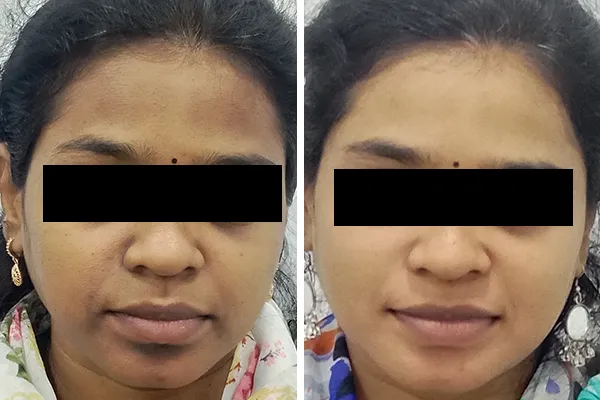 Hydrafacial® - The best skin care clinic in India | VCare