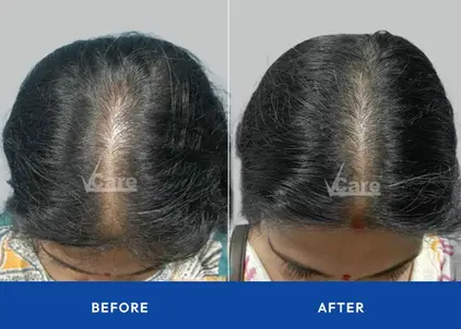 Prp Booster | Prp 360 | Prp Treatment | Hair Regrowth Treatment